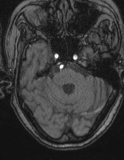 Choroid Plexus Xanthogranuloma Unilateral Radiopaedia 85632 101393