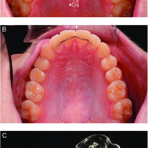 A Bonded Retainer 13 23 B Bonded Retainer 12 22 And C