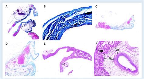 Figure 6 From Safety And Efficacy Of The Second Generation Cryoballoon