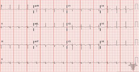 Wellens Syndrome Ecg Stampede