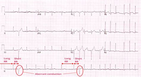 Atrial Fibrillation Ecg Book