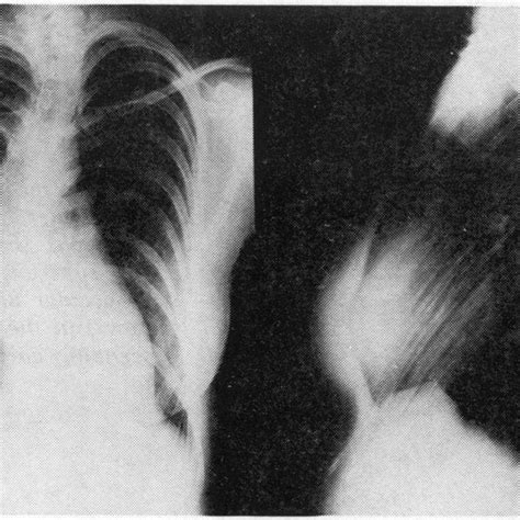 Aortogram Showing Fusiform Dilation Of The Ascending Aorta Which Is Download Scientific Diagram