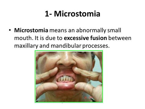 Developmental Disturbances Of Oral Tissues Ppt Video Online Download