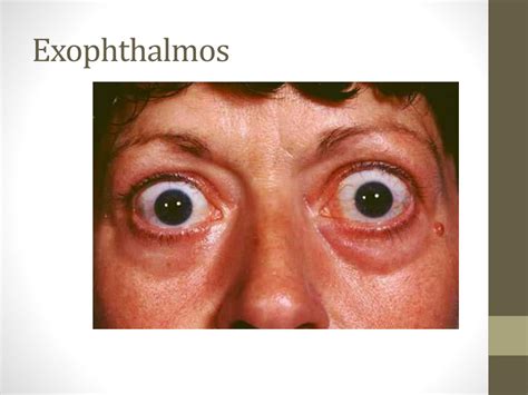 Ppt Bismillahirrahmanirrahim P Hysical Examination Of Thyroid Disease