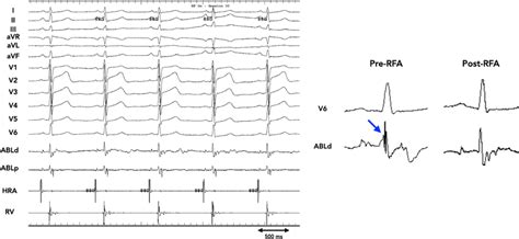 Surface Electrocardiogram And Intracardiac Electrogram After 35 Download Scientific Diagram