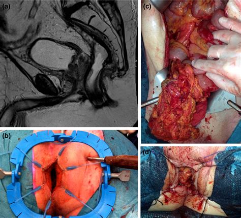 Perineal Proctectomy