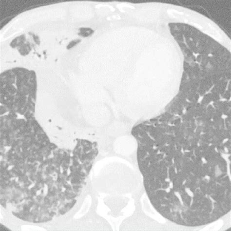 Multiples Areas Of Centrilobular Nodules With A Linear Branching