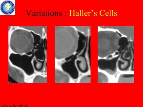 Imaging For Endoscopic Sinus Surgery
