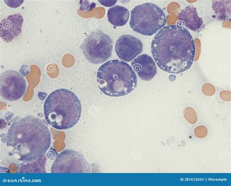 Acute Myeloid Leukemia With Pseudo Chèdiak Higashi Anomaly Stock Image Image Of Diseases