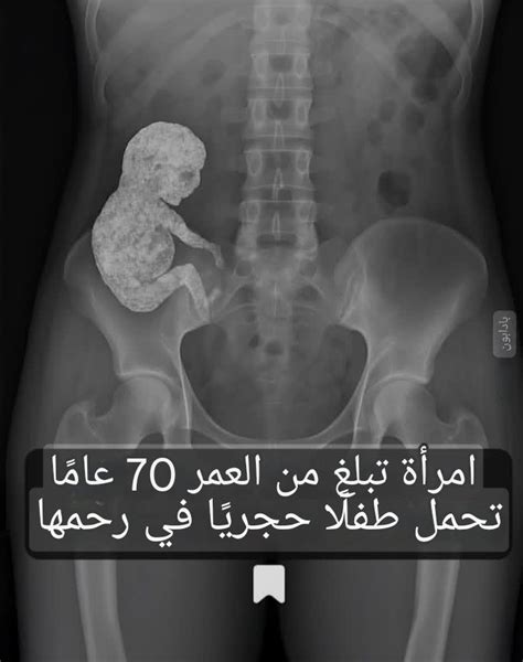 كنوز عاشت معه لمدة 40 سنة دون أن تعرف ظنت أنه ورم، فتق أو فقط بسبب تقدم العمر لكن لا