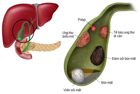 How Are Gallbladder Polyps Diagnosed And Treated Vinmec