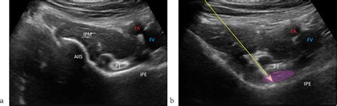 Comparison Of Peng Block With Lfcn And Ficb In Ahs Jpr