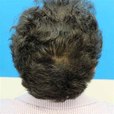 Finasteride Topica Gel Al 25 Dati Handw Su Preparazione Della