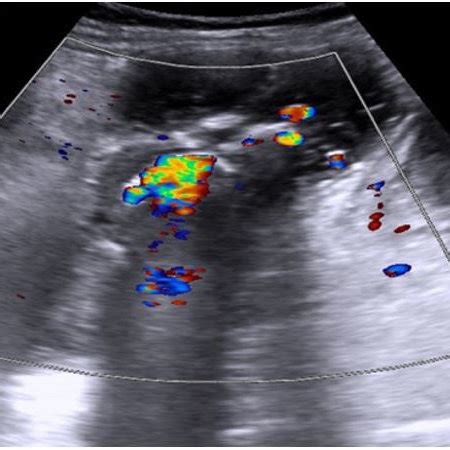 Abdominal Usg Showing A Calculus And Left Psoas Abscess A And B A