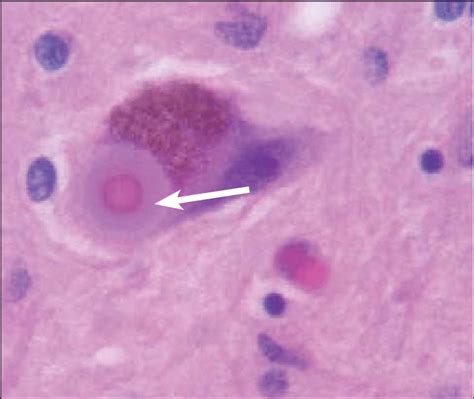 Lewy Bodies That Contain Alpha Synuclein And Other Proteins This Is