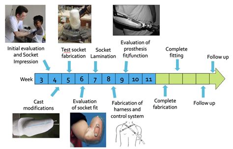 Transradial Hinged Prosthesis Upper Limb Prosthetics Techniques