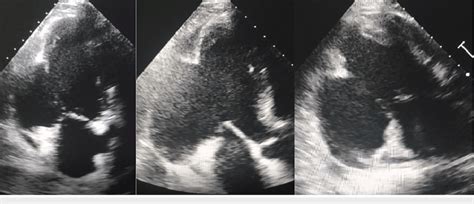 Tte Showing A Large Submitral Aneurysm Free Of Thrombus With A Wide