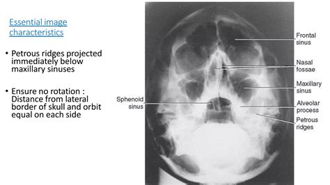 X Ray Pns Pptx