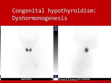 Thyriod Gland Imaging Part 5 Molecular Imaging Nuclear Imaging Spect