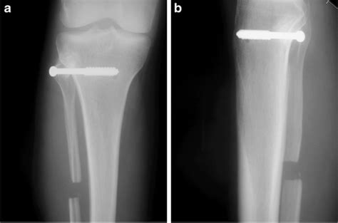 Successful Fusion Of The Proximal Tibiofibular Joint With Osteogenic Protein 1 Op 1