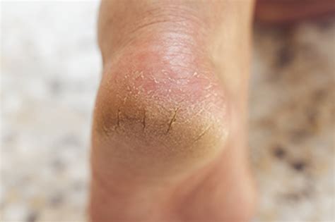 Exploring The Causes Of Cracked Heels