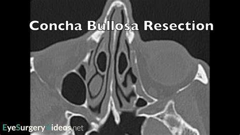 Concha Bullosa