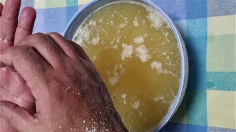 التهاب وتر الابهام علاج نهائي وفعال وممتاز ومجرب Youtube