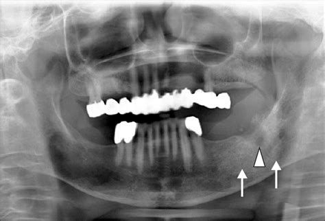 A Dental Panoramic View Demonstrates Osseous Sclerosis Arrow And