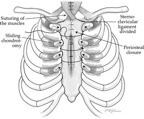 Thoracic Defects Cleft Sternum And Poland Syndrome Semantic Scholar