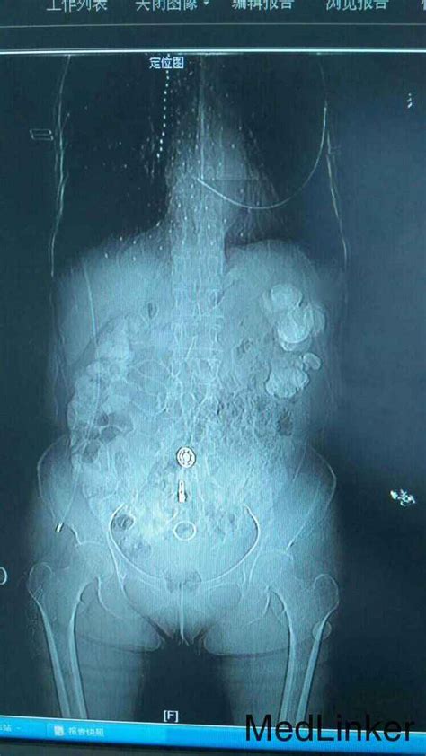 孤肾巨大铸型结石伴输尿管末端结石 医联