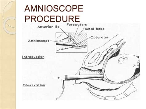 Aminoscopy And Fetoscopy Invasive Procedurepptx