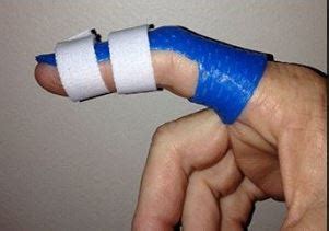 Swan Neck Deformity Merivale Hand Clinic