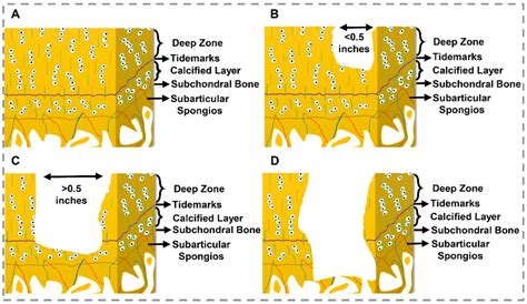 Osteochondral Defect Grades A Normal Cartilage Grade 0 B