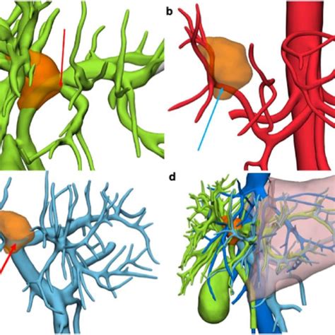 3d Visualization Technology Of A Case Of Peri Hilar Cholangiocarcinoma