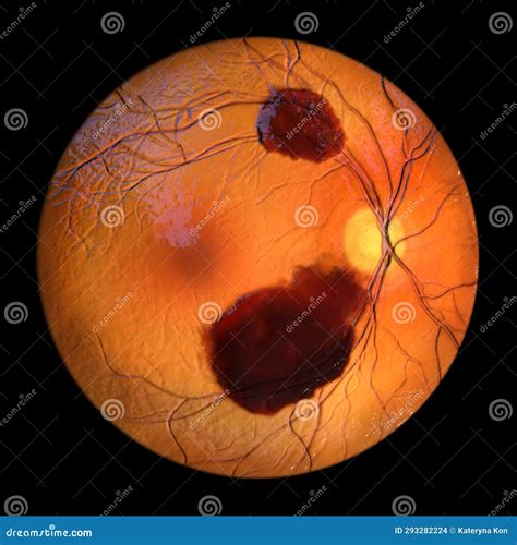 A Subretinal Hemorrhage As Observed During Ophthalmoscopy 3d Illustration Royalty Free Cartoon