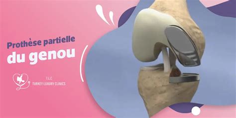 Prothèse Partielle Du Genou