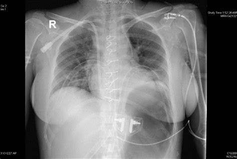 Postoperative Chest X Ray Showing The Permicath Inserted In The Right