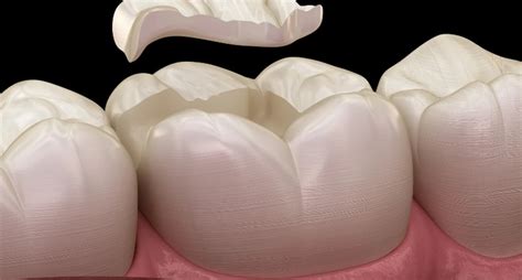 What To Expect During A Tooth Crown Procedure Flexable Health