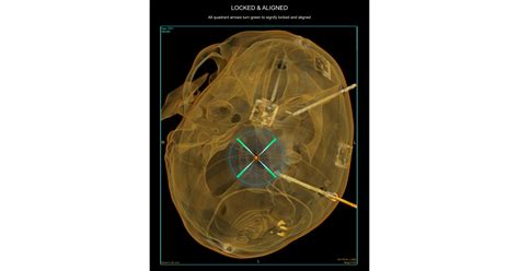 novarad s visar system demonstrates high accuracy for evd placement
