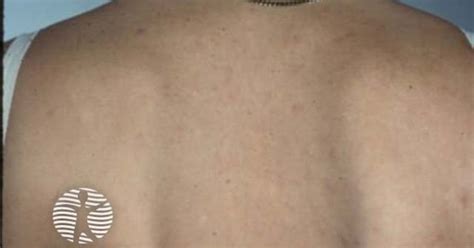 Secondary Syphilis Image