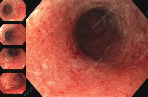 Colon In Ulcerative Colitis Endoscope Views Stock Image C Science Photo Library