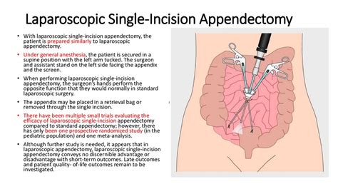 Appendectomy By Mohan Krishna Redlapalle презентация онлайн
