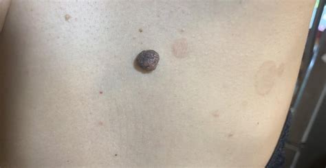 Anyone Recognize These Roundish Spots Under My Left Breast No Itching