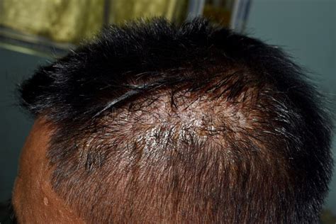Seborrheic Dermatitis Scalp