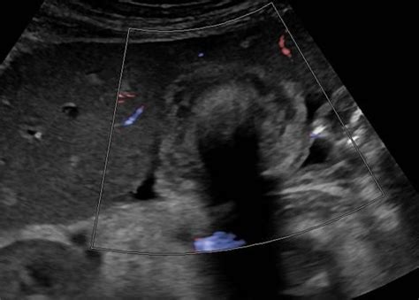 Abdomen And Retroperitoneum 12 Gallbladder And Bile Ducts Case 12