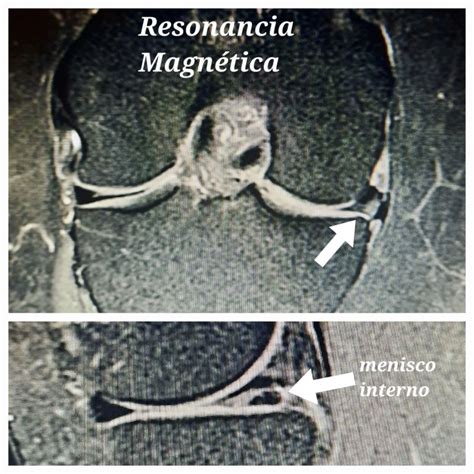 Rotura Del Menisco Interno De La Rodilla Resonancia Magnética