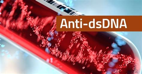 Anti Dsdna Laboratory Test What Is It Sciencecodons
