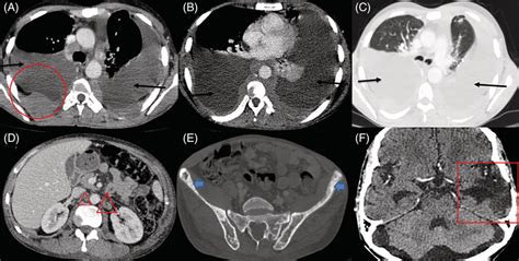 Computed Tomography Ct Scan A B Axial Ct Slices After The