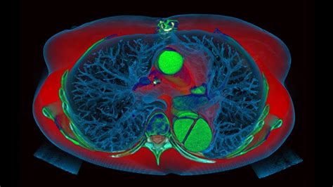 Aortic Dissection 3d Reconstruction Ct Youtube