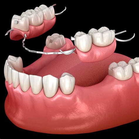 Global Removable Partial Dentures Industry Foresees A 4 5 Cagr Aiming To Achieve A Sum Of Us